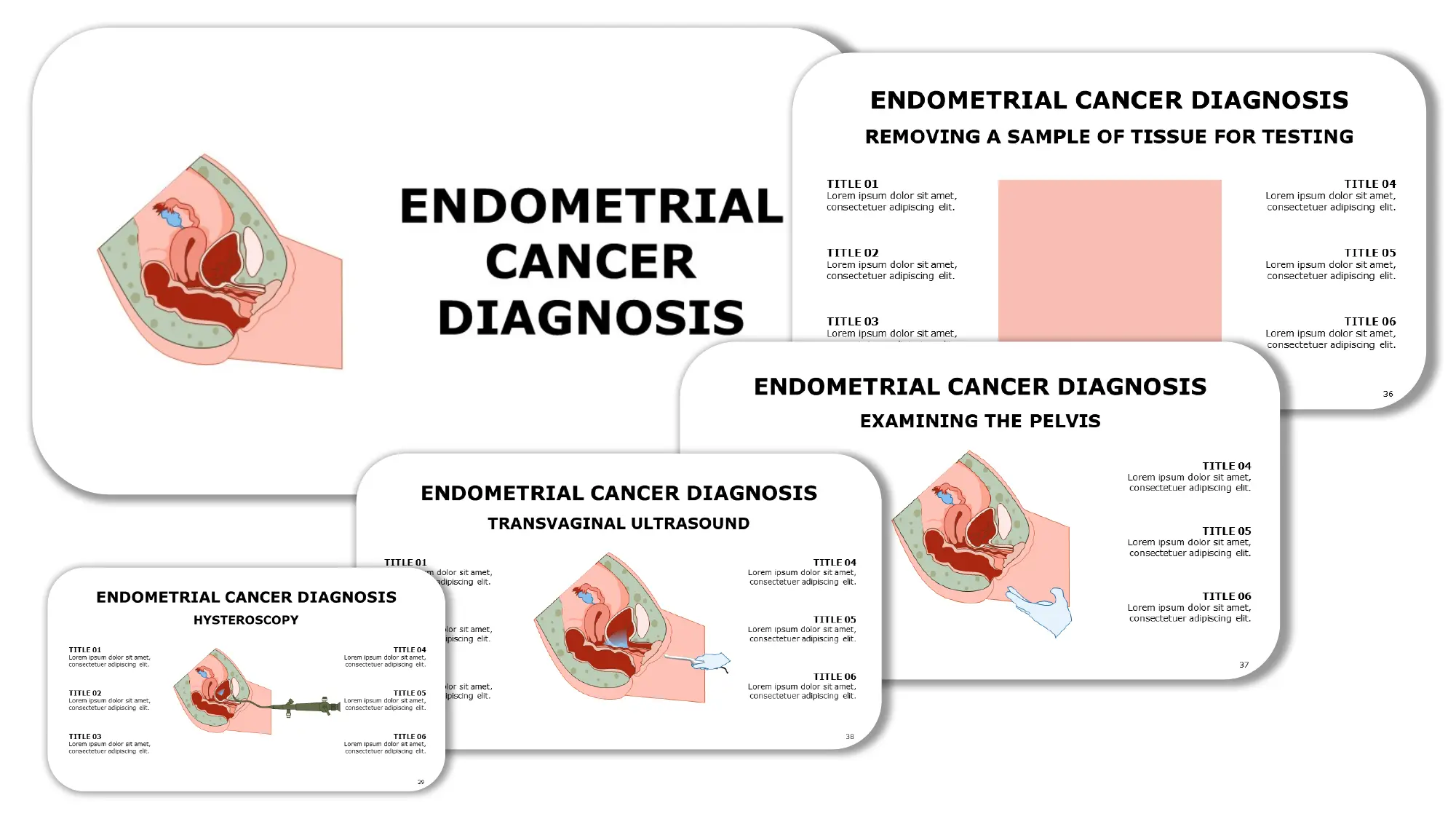 Download Endometrial Cancer PowerPoint Template| RxSlides
